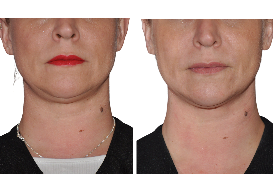 Strawberry Lift - Non-Surgical Facelift & Laser Lipo Inch Loss ...
